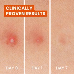 3-In-1 Spot Patches | Spot Control